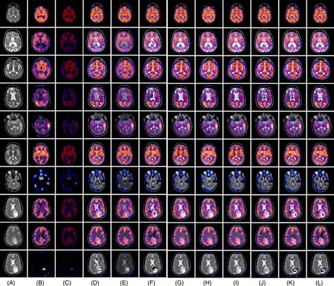 Multimodal Fusion Results Of Real Neurological A MR Images B SPECT
