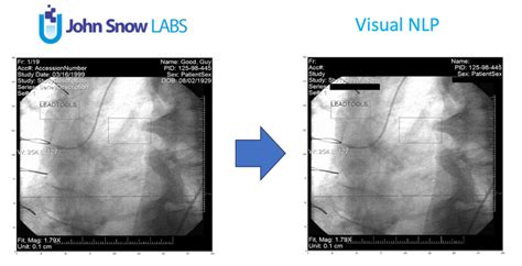 Dicom De Identification At Scale In Visual Nlp Part 1 Mykola Melnyk