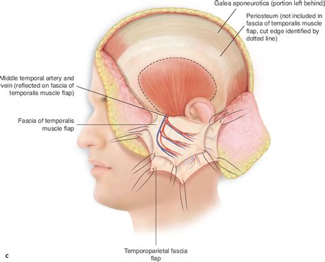 Temporal Fascia