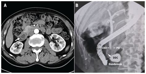 Duodenal Duplication Cyst In A 61 Year Old Man Cmaj