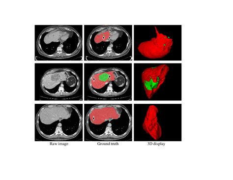 Arxiv On Twitter H Denseunet Hybrid Densely Connected Unet For Liver And Liver Tumor