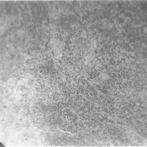 Histopathologic Specimen Of Excised Granulation Tissue Hematoxylin