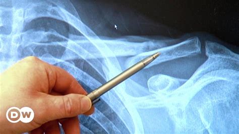 Reposo u operación como se trata una fractura de clavícula En forma