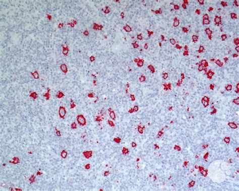 Nlphl With Progression