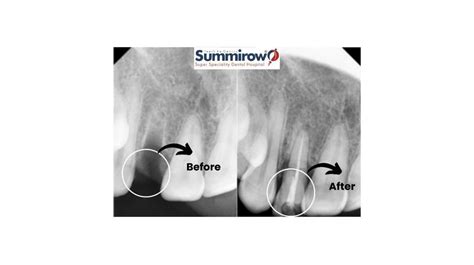 Successful Management Of Horizontal Root Fracture With Immediate Implant And Crown Restoration