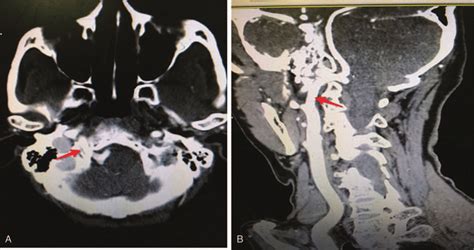 The Vessel Entered The Skull Base Through The Hypoglossal Canal A
