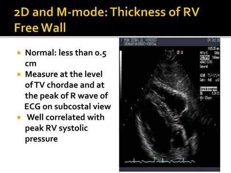 75574537 Assessment Of Right Ventricular Functionppt