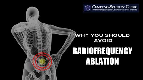 Why We Dont Perform The Radiofrequency Ablation Procedure