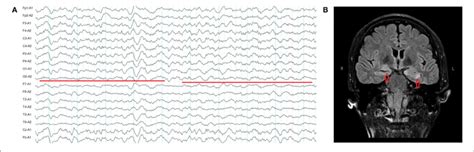 A Severe Diffuse Polymorphic Slowing In Patient 1 Red Line B