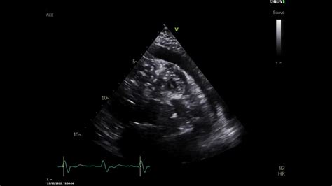 Leadless Pacemaker Implantation In Eisenmenger Syndrome Revista