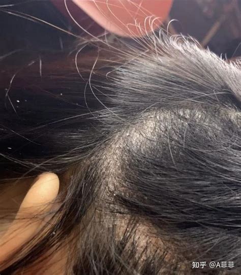 脂溢性皮炎头皮洗发水 知乎