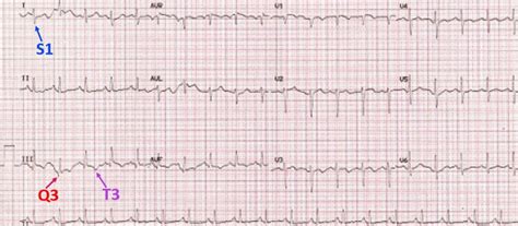 Pulmonary Disease Pattern Ecg Hình ảnh Có Liên Quan Diseases Club
