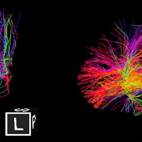 Tracts With Significant Group Specific Effects Of Wm Microstructure Download Scientific