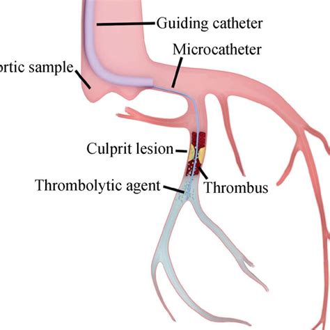 Comparison Of Antegrade Thrombolysis Vs Retrograde Thrombolysis In Download Scientific Diagram