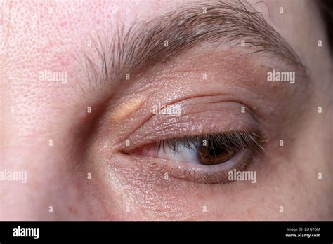 Xanthomas Pictures Eyes Clipart