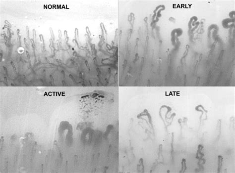 Training In Capillaroscopy A Growing Interest The Journal Of