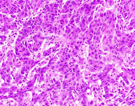 Carcinoma