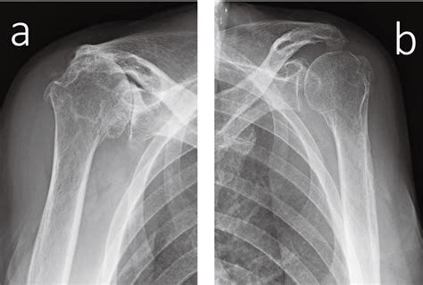 A Preoperative Plain X Ray Of Case 2 A Right Shoulder Joint Larsen Download Scientific