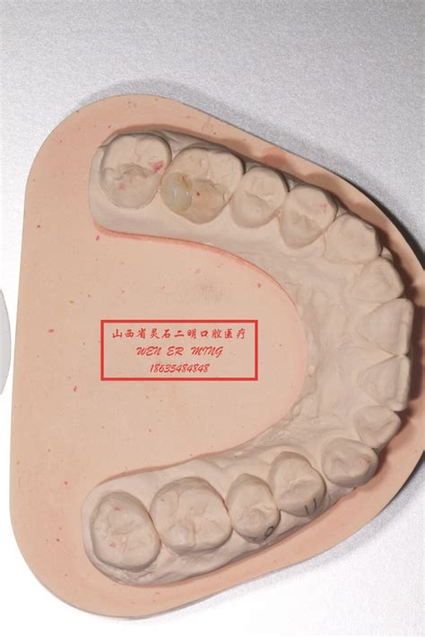 原来补牙也可以这么爽记一例活髓牙铸瓷嵌体病例 温二明的博客 KQ88口腔博客