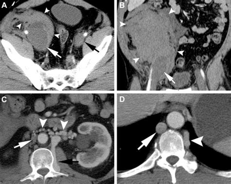 Single Session Total Endovascular Iliocaval Reconstruction With Stent