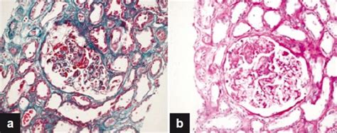 Glomerulus Showing Segmental Fibrinoid Necrosis Arrow And