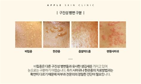 비립종 원인 증상 및 효과적인 치료 방법 총정리