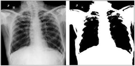 X Ray Image Before And After Euler Based Segmentation The Euler Based Download Scientific