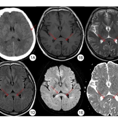 Figure Mild Hace Patient A Ct Plain Scan Showed That The Sulcus And