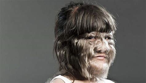 Rapunzel Syndrome Latest News On Rapunzel Syndrome Read Breaking