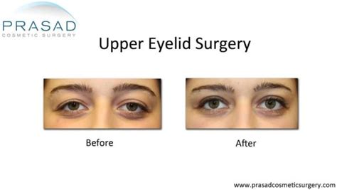 What Causes Heavy Lidded Eyes And How To Treat Them