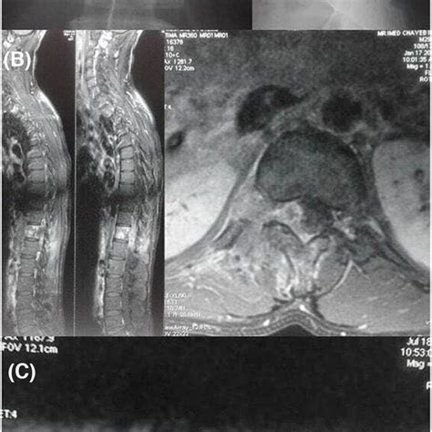 A Standard X‐ray Antero‐posterior And Lateral View Showing A