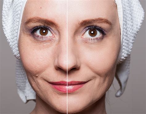 Dpl Laser Treatment Melbourne Skin Rejuvenation And Facial