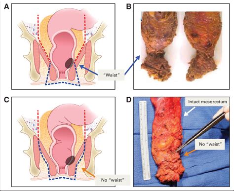 figure 1 from advances and challenges in treatment of locally advanced