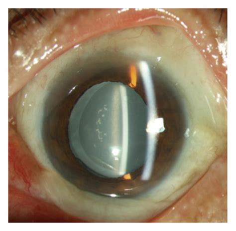 Photographs Of The Distinct Case Of Iol Opacification A E The Download Scientific Diagram