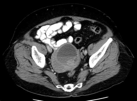Uterine Leiomyosarcoma Image