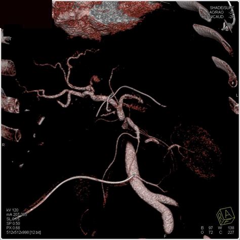 Perforated Gastric Ulcer With Bleed Stomach Radiology Case Studies