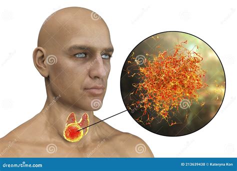 Thyroid Cancer Illustration Showing Tumor Inside Thyroid Gland And