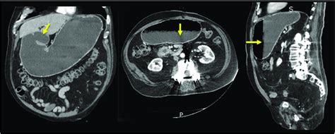 Ct Scan Of The Abdomen And Pelvis With Contrast Showing Severe