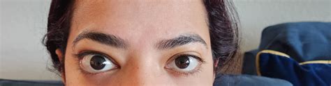 Eyelid Closure Surgery During Active Phase Of Ted Rthyroideyedisease