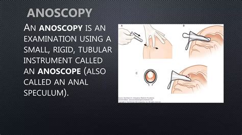 Digital Rectal Examinationpptx Pptx