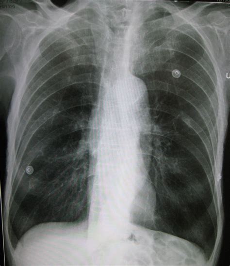 Lungenemphysem Frischer Schwung Für Leben Und Lunge