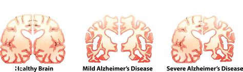 Alzheimer S Disease Illustration Science Severe Alzheimers Disease