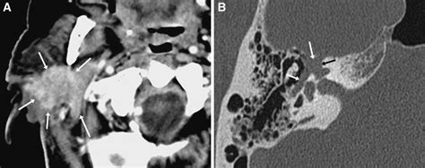 Perineural Spread Of Tumor A Axial Ct Image In Soft Tissue Algorithm