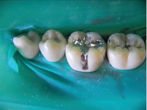 Amalgam Placement Carving Finishing And Polishing Pocket Dentistry