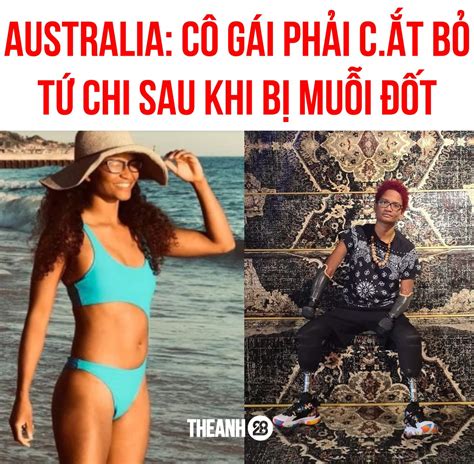 ChỈ VÌ BỊ MuỖi ĐỐt Tatiana Timon 35 Tuổi đến Từ Camberwell đã