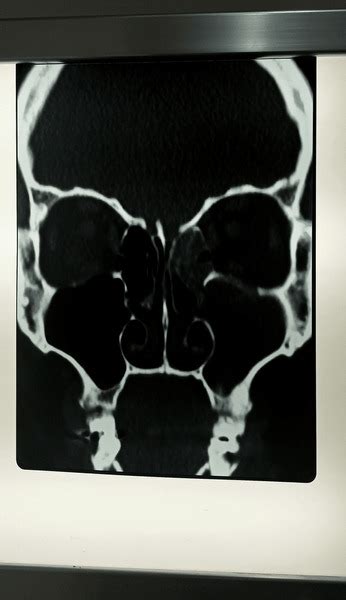 Paranasal Sinuses Coronal Ct Scan Labelled