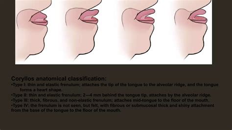 Ankyloglossia Cp Pptx