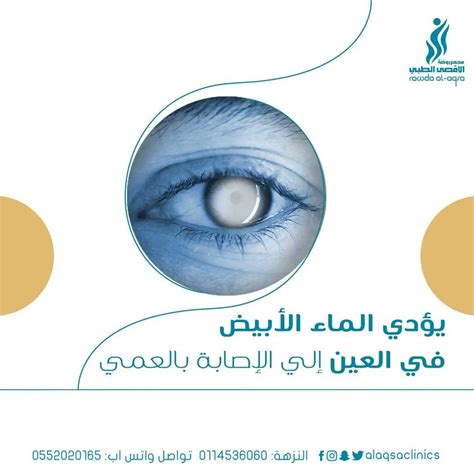 🔺 يؤدي الماء الأبيض في العين الى الأصابة بالعمى