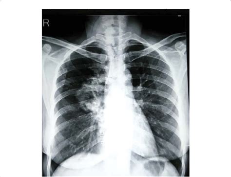 Chest X Ray Showed Ill Defined Rounded Heterogeneous Opacity Download Scientific Diagram