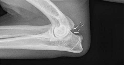 Olecranon Fossa X Ray Elbow Olecranon Fractures Dr Groh